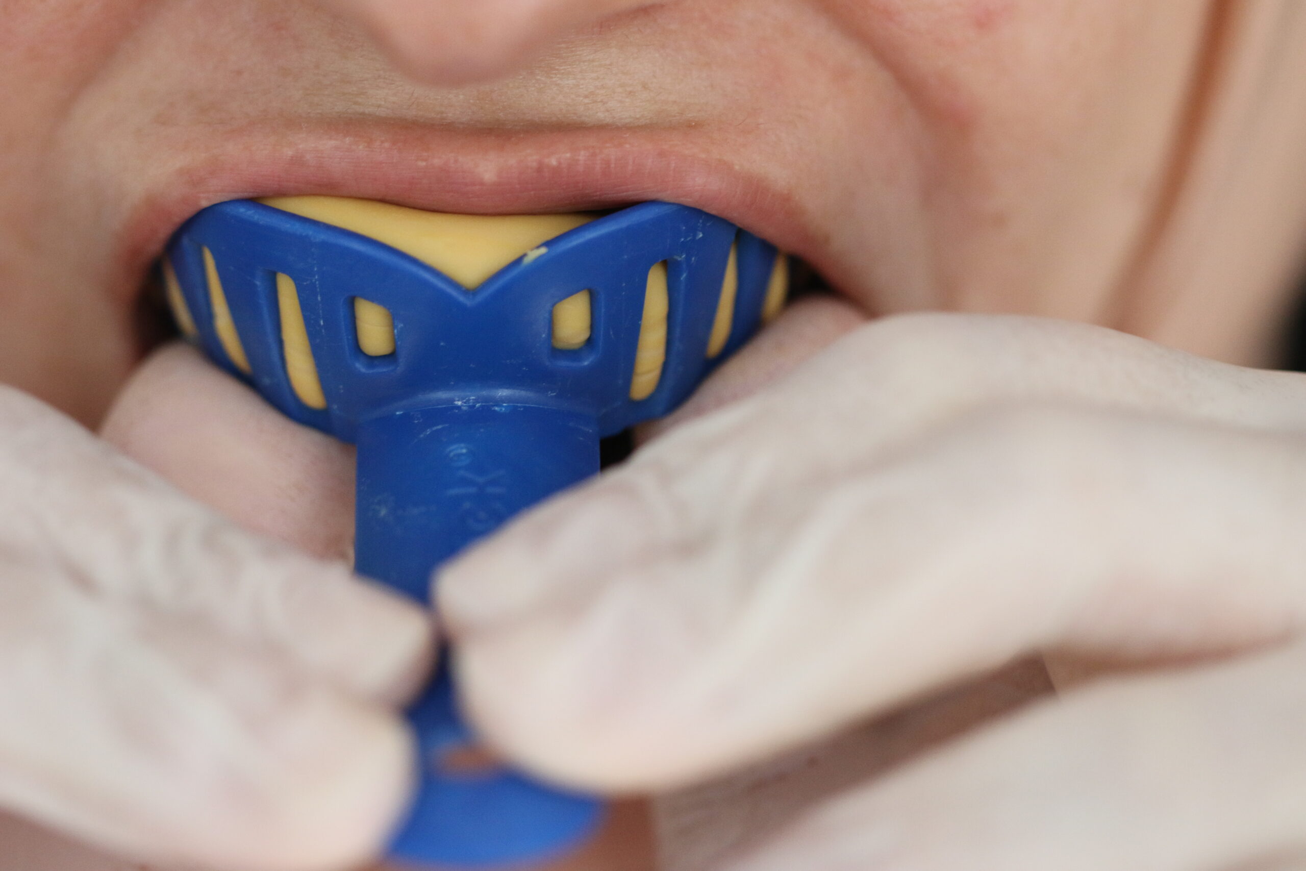 How to take impressions? - Selfdentist