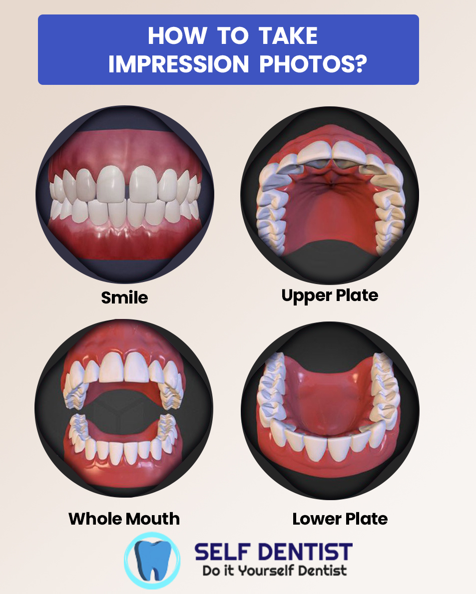 Impression photos - Selfdentist